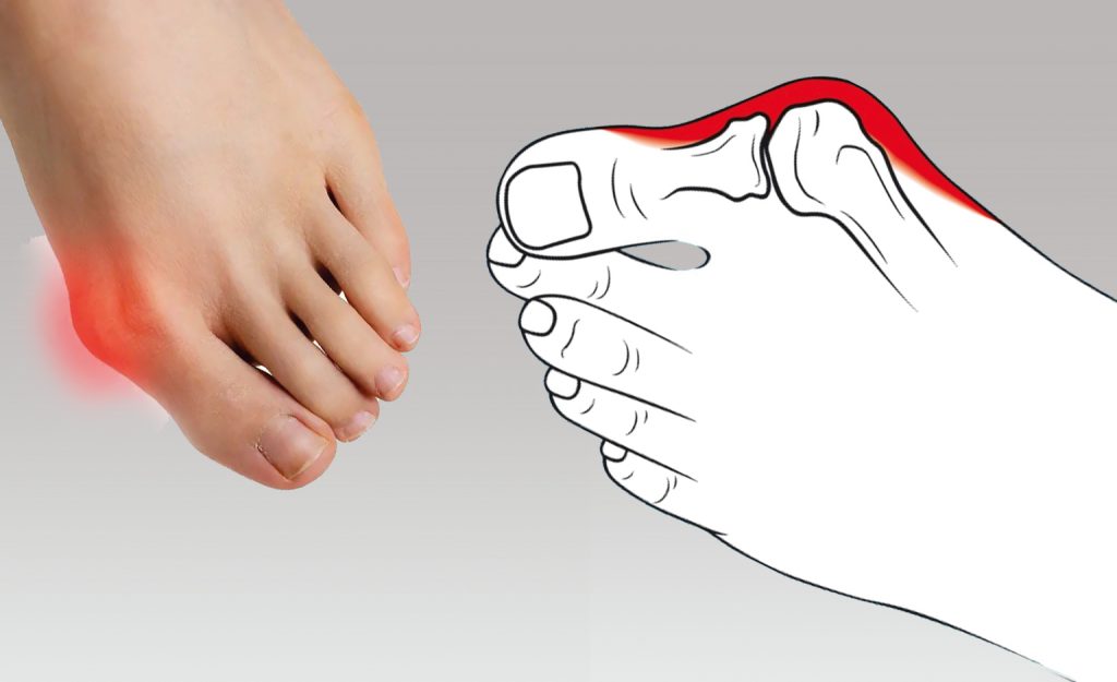Hallux Valgus – APM Indaiatuba
